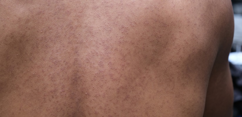 Bumps and Rashes: Common Skin Conditions Explained - Le Bonheur ...